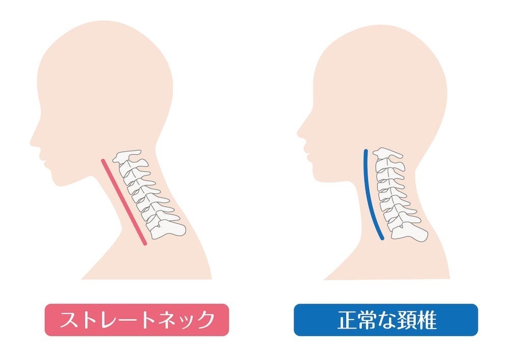 首 上むいたら痛い｜原因・対処法・危険な痛みの見分け方まで徹底ガイド - 世田谷区 おかじま接骨院／自由が丘駅徒歩7分、九品仏駅徒歩2分の通い ...
