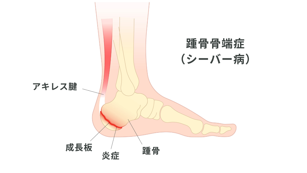 【かかとが痛い】シーバー病を早く治す方法とは？簡単なストレッチ・筋トレを解説 - 株式会社リハサク